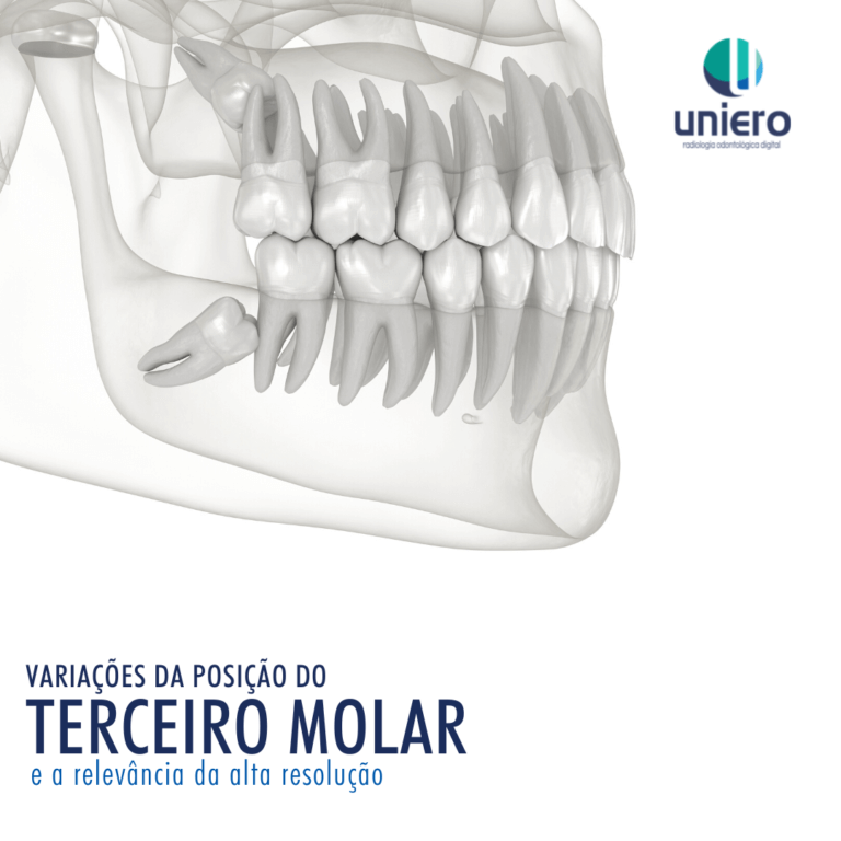 Variações da posição do Terceiro Molar - Uniero