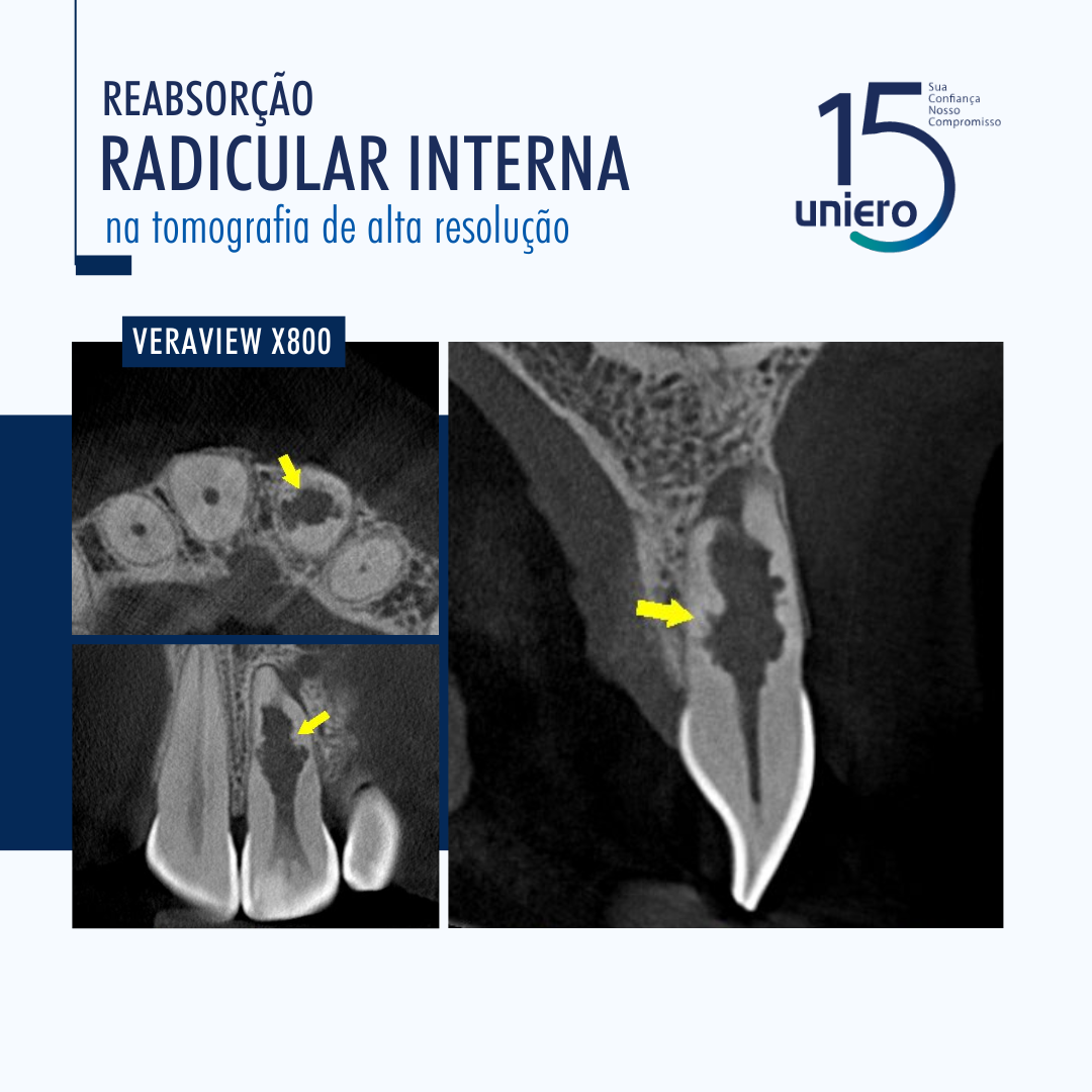 Reabsorção radicular interna na tomografia de alta resolução - Uniero